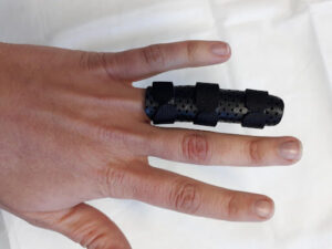 Splints & Casts - The Hands Physio | Action Rehab