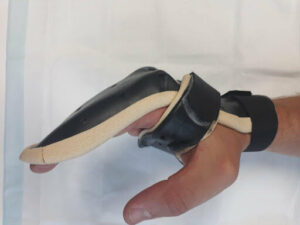 Splints & Casts - The Hands Physio | Action Rehab