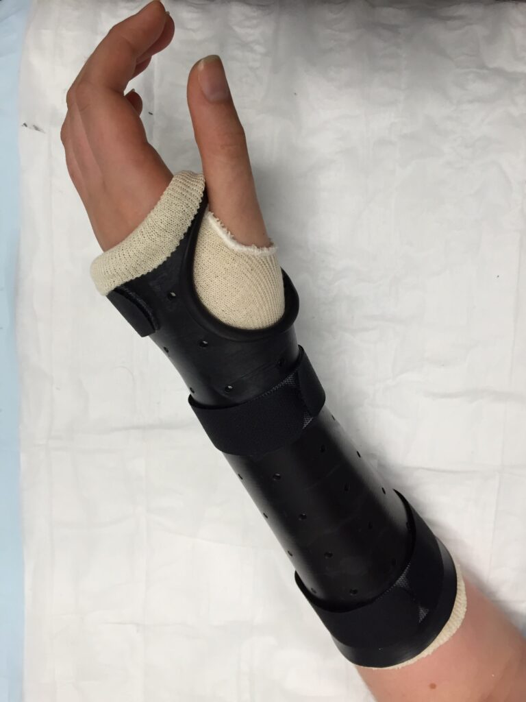 Scaphoid Fractures Treatment Sydney