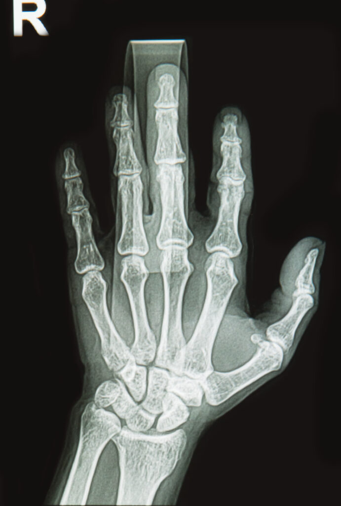 Sprained or Fractured Fingers Treatment Sydney